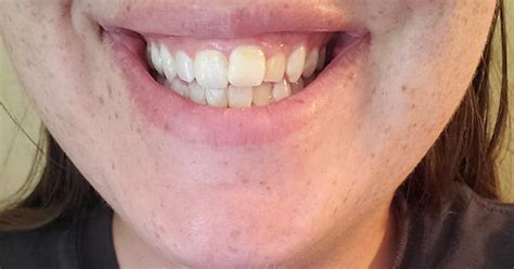 My Teeth Album On Imgur