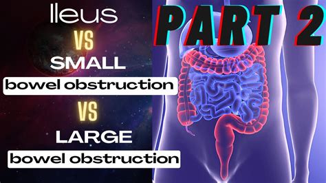 General Surgery Small Bowel Obstruction Vs Large Bowel Obstruction Vs