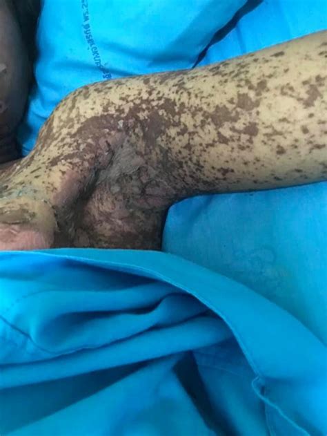 S C V I H Nh Nh C G I B D Ng To N Th N M T Bi N D Ng Do D Ng Thu C Ch A Au R Ng Khi N