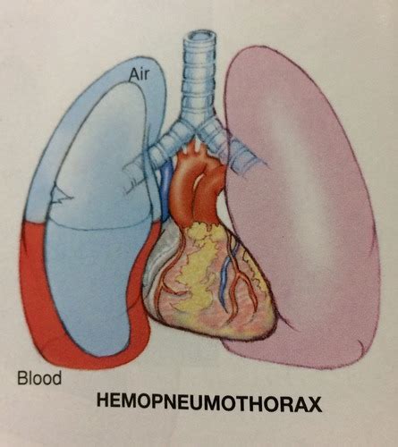Pathophysiology Respiratory Disorders Flashcards Quizlet