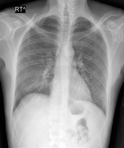 Radiopaedia Case Septic Pulmonary Emboli And Chest Wall Abscess Id