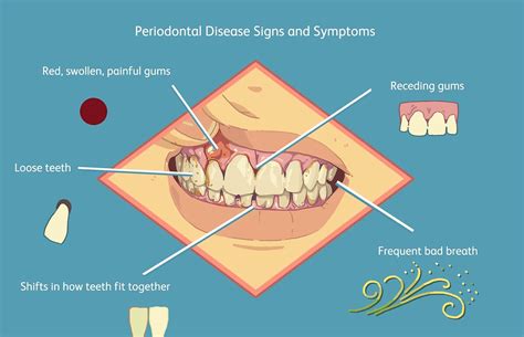 What Are The Symptoms Of Periodontal Disease