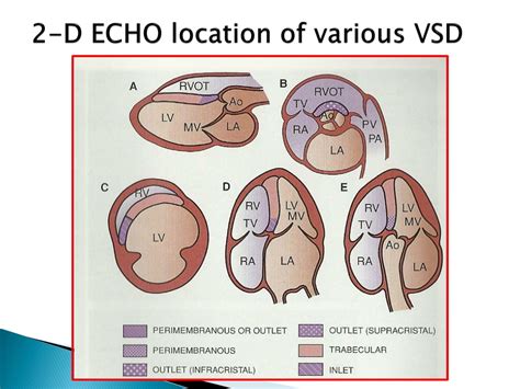 Ppt Echo Assessment Of Vsd Powerpoint Presentation Free Download