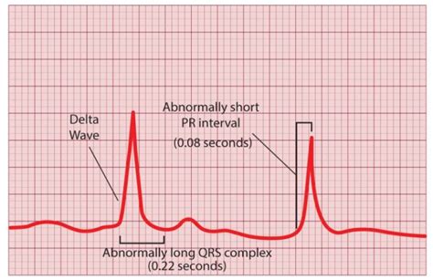 Delta Wave Ecg