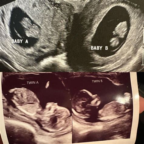 [pick] 100만분의 1 확률…자궁 2개에 각각 임신한 美 여성 화제 네이트 뉴스