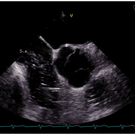 Intraoperative Transesophageal Echocardiography TEE Showed Gas Download Scientific Diagram