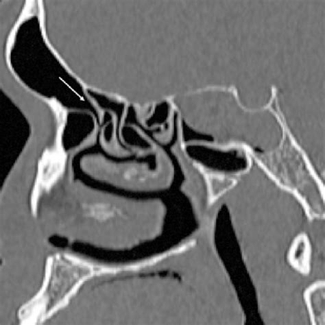 Normal Frontal Recess Anatomy Sagittal Ct Image Shows The Right Download Scientific Diagram
