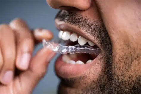 Can Invisalign Fix Overbite Clear Aligners As Modern Option