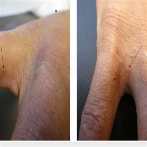 Scabies Burrows On The Web Space Between The Digits On The Right Hand