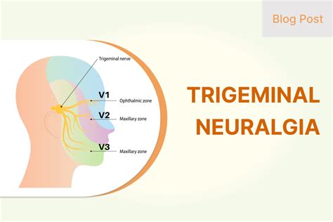 Trigeminal Neuralgia Treatment At Amandeep Hospital Expert Care