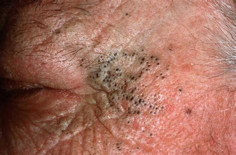 Acne And Pimples Caises Best Treatment To Get Rid Of Acne And Pimples