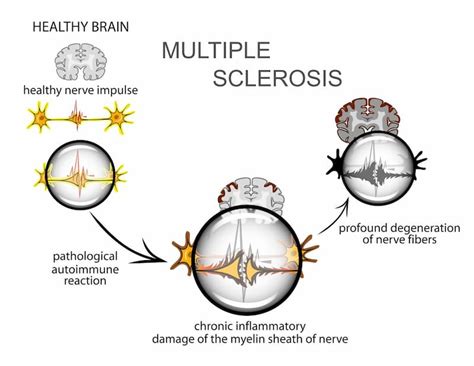 Types Of Multiple Sclerosis 4 Forms Of Ms Swiss Medica