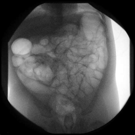 Intussusception X Ray