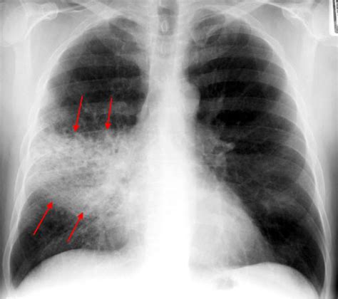 Radiology Pneumonia Flashcards Quizlet