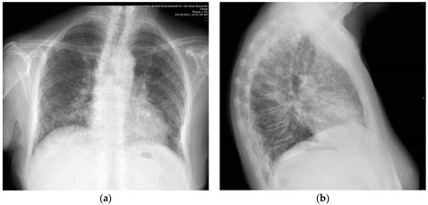 Fibrotic Lung X Ray