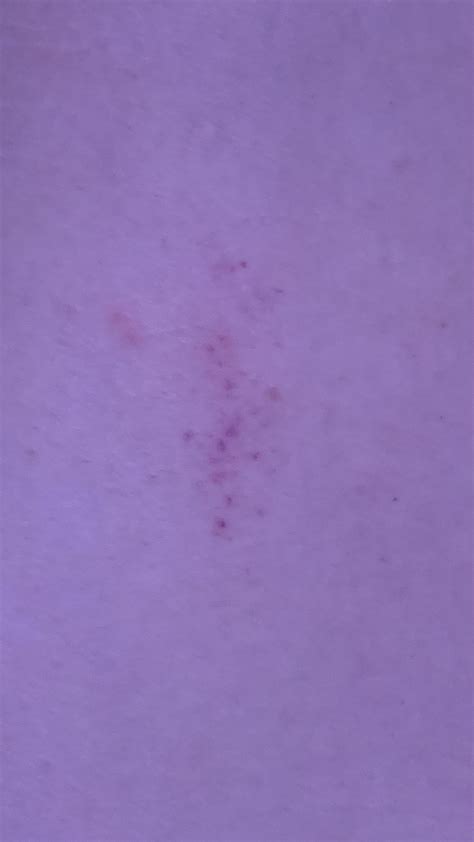 Red Itchy Spots On Inner Thighs Rskin