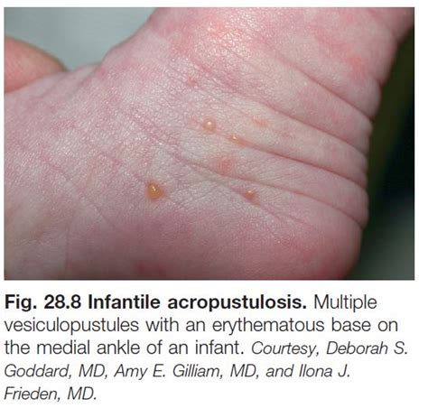 Infantile Acropustulosis