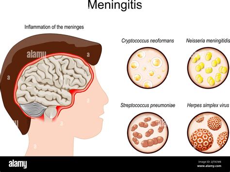 Meningitis Rare Disease At Alton Phelps Blog