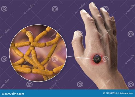 Cutaneous Anthrax The Most Common Form Of Anthrax Stock Illustration