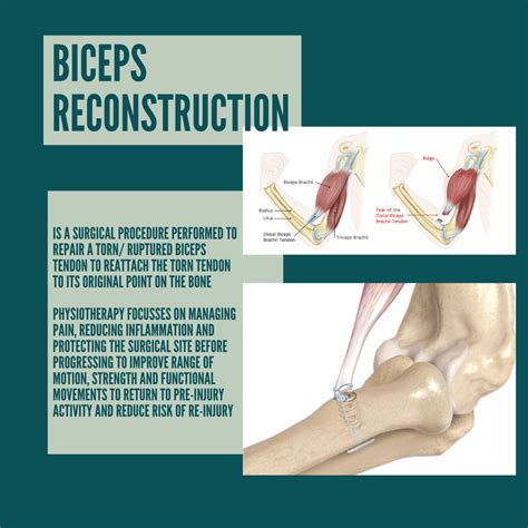 Biceps Reconstruction Brisbane Physiotherapy And Podiatry