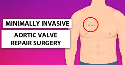 Is Minimally Invasive Aortic Valve Repair Possible