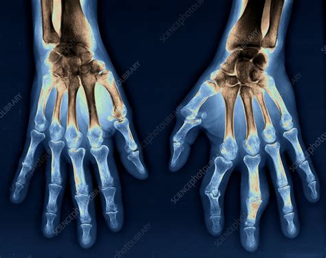 Rheumatoid Arthritis X Ray Stock Image C0529579 Science Photo