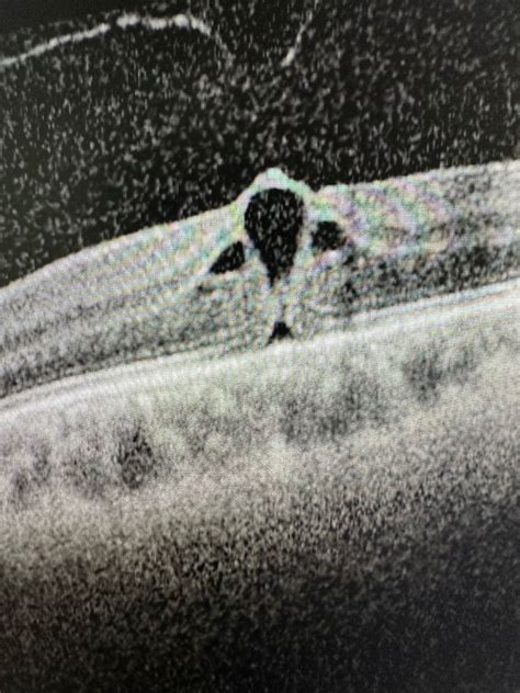 Henry Hudson The Patient Vmt Grade 3 To Stage 2 Ftmh To Vmt Grade 2 Over 5 Months The Traction