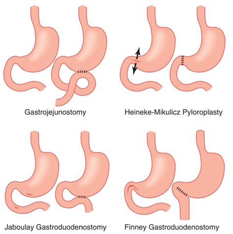 Vagotomy And Pyloroplasty