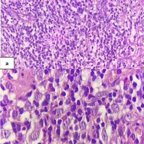Polyp Lined By Endocervical Lining Scanner Download Scientific Diagram