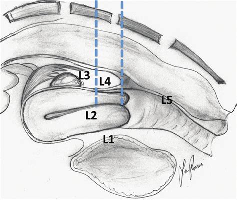 Schematic Representation—location Of Endometriotic Nodes In The Pelvis