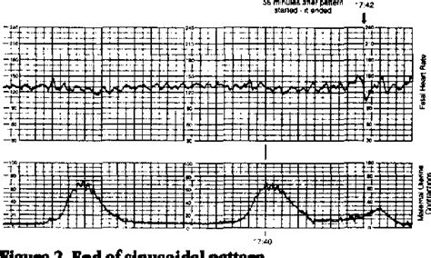 Figure 1 From Sinusoidal Fetal Heart Rate Pattern After Administration