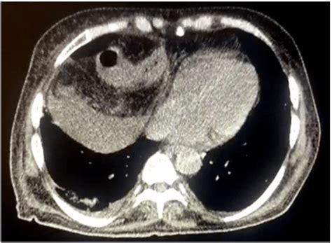 Ct Scan Showing A Morgagni Hernia Download Scientific Diagram