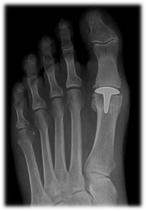 Big Toe Joint Replacement Surgery Hammertoe Treatment Podiatrist Near Augusta Atlanta