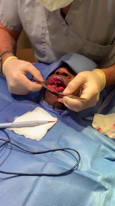 Closure Of Lip Reduction Surgery Video Realself