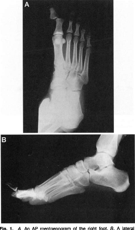 Figure 1 From Irreducible Dorsal Dislocation Of The Great Toe