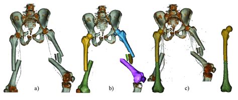 The Virtual Fracture Reduction Surgery In The Space Environment A 3d Download Scientific