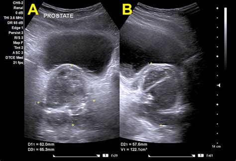 A Rare Case Of A Prostatic Abscess Secondary To A Mycoplasma Hominis
