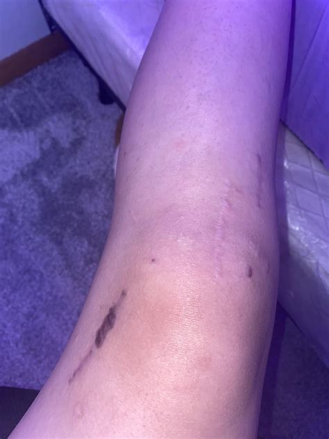 What Can Help Fade Surgery Scars Racl