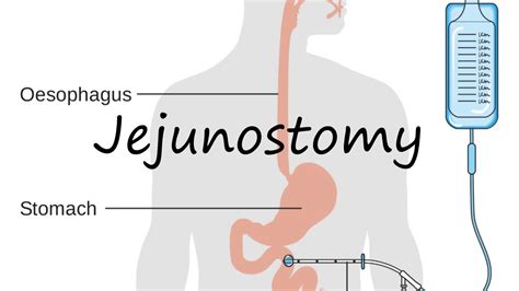 How To Pronounce Jejunostomy Youtube
