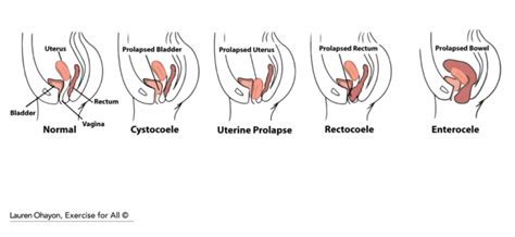 Uterine Prolapse To Be Uterine Prolapse Pelvic Floor Pelvic Floor