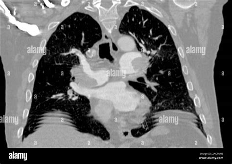 Pulmonary Embolism Computed Tomography Ct Scan Of A Section Through A 65 Year Old Male