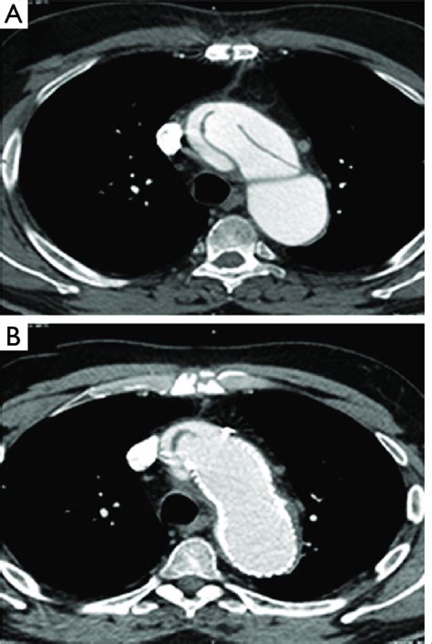 Patient Control After Treatment Of Aortic Arch By Ct Scan A