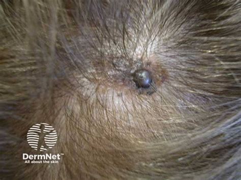 Nodular Melanoma Scalp