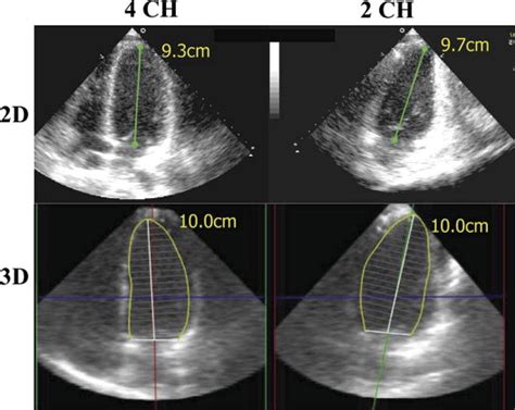 New Advances In Quantitative Echocardiography Journal Of Nuclear