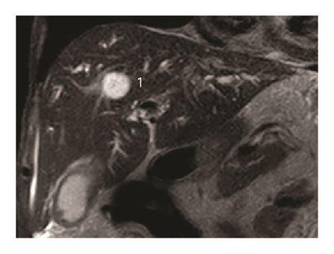 Imaging Findings In A Patient With IgG Related Sclerosing Cholangitis Download Scientific