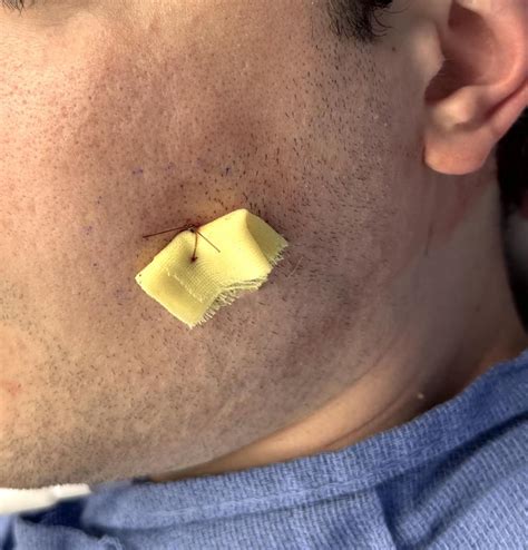 Cheek Bolsters For Buccal Lipectomy Reversal Dr Barry Eppley Explore