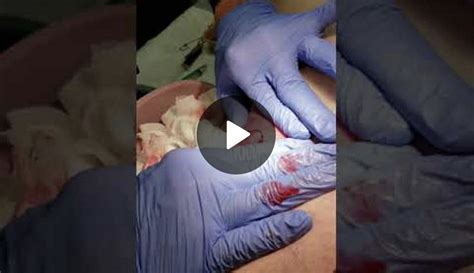 Spider Bite Infection On Woman Turned Into Abscess Rblackhead