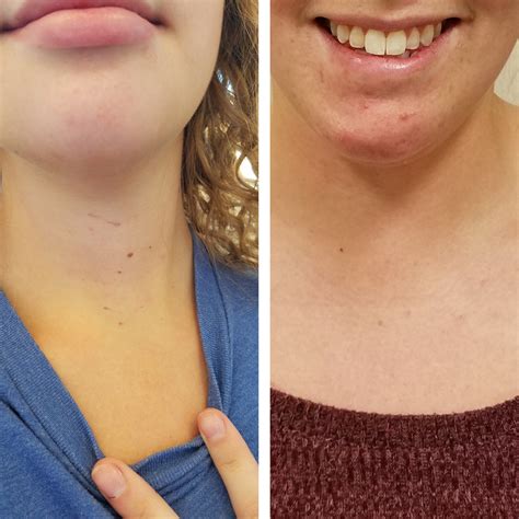 Completely Scarless Thyroidectomies Johns Hopkins Medicine