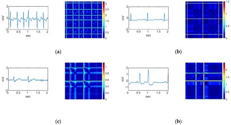 Ecg Recurrence Plot Based Arrhythmia Classification Using Two