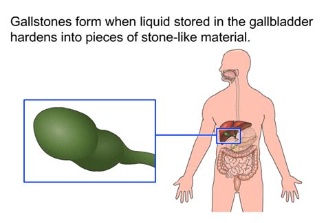 Gallstones